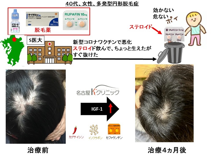 脱毛薬ルパフィンと新型コロナワクチンで悪化した円形脱毛症が改善！ 患者様からの声・メディア掲載・クリニックからのお知らせ 名古屋kクリニック